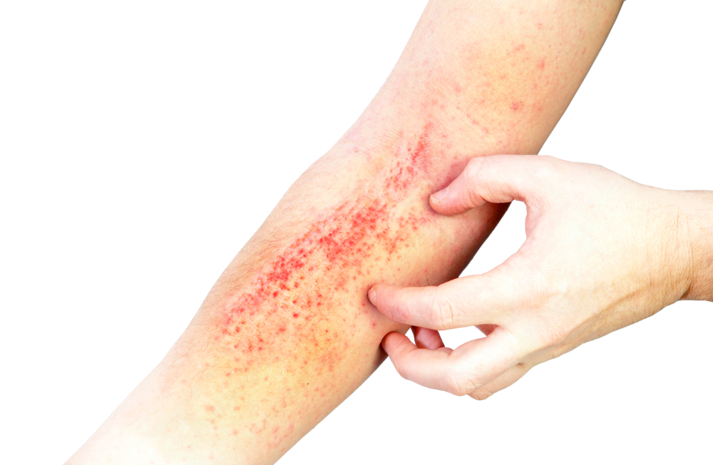 e3arabi - إي عربي – التهاب الجلد القيحي - Pyodermatitis